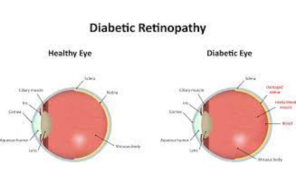Retinopati Diabetik: Definisi, Penyebab, Gejala, Faktor Risiko, dan ...